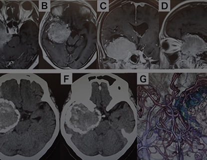 傍鞍部腫瘍性病変に対する術野展開のコツとPitfalls | INTEGRA ONLINE